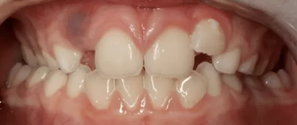 What is an expander ? | Read all you need to know here.