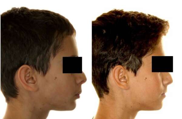 Mara Appliance | Gilbert Orthodontics - read more here.