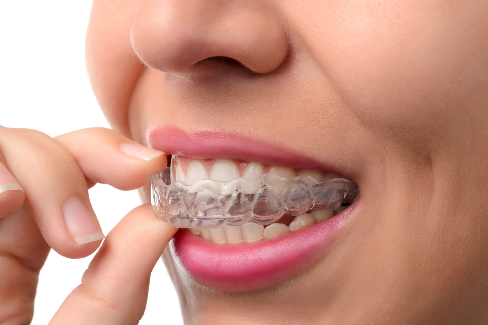 Dr. Gilbert on Invisalign: Clear Solution for Straighter Smiles